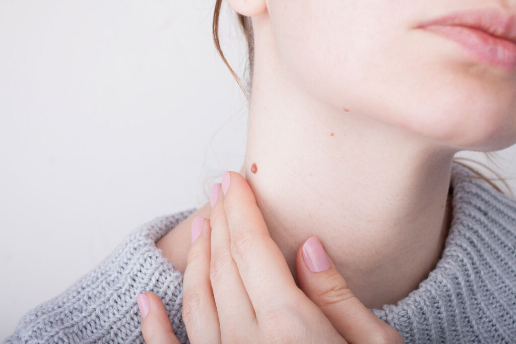 Warts - AboutSkin Dermatology and DermSurgery, PC. - Denver ...