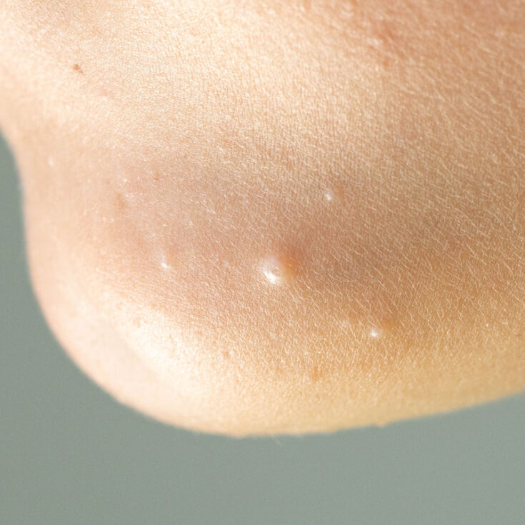 Molluscum Contagiosum - AboutSkin Dermatology and DermSurgery, PC. - Denver Dermatologist ...